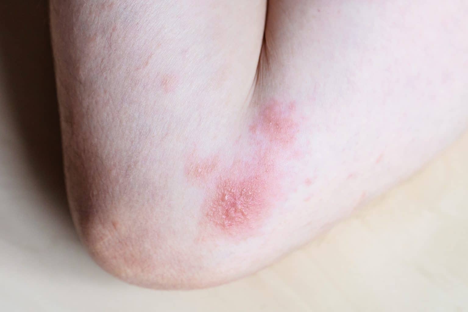 Best Cream for Contact Dermatitis: A Complete Guide to Relief - Bragan ...
